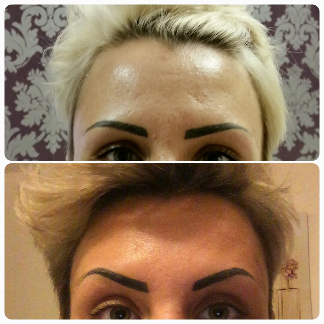 Botox brow lift - Dr Hannah Wilson | Infinity Skin Clinic